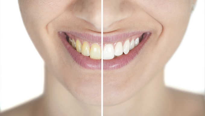 Zahnbleaching - Ganzheitliche Zahnmedizin. Gesund im Mund.